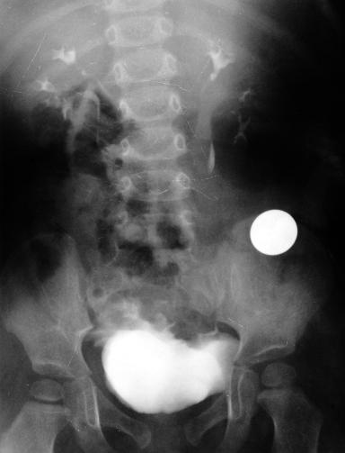 Cloacal Exstrophy Bottom | W. Hardy Hendren Pediatric Surgical and ...