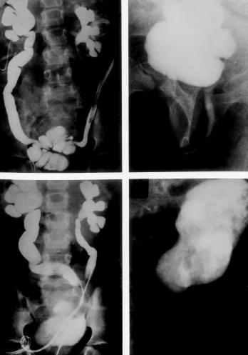Urinary Tract Reconstruction Patient 1: Undiversion Case with Cloacal ...
