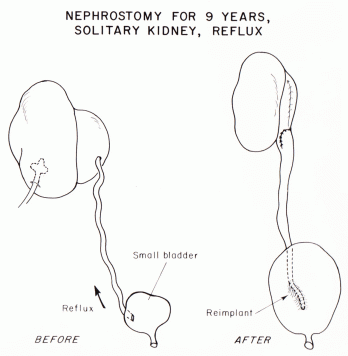 Urinary Tract Reconstruction Patient 2: Severe Hydronephrosis in a ...