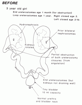 Urinary Tract Reconstruction Patient 4: Undiversion Using Gastric ...
