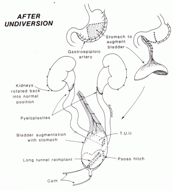 Urinary Tract Reconstruction Patient 4: Undiversion Using Gastric ...