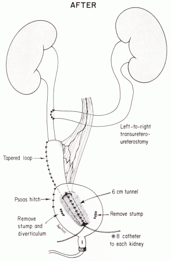 Urinary Tract Reconstruction Patient 5: Undiversion by Removing an ...
