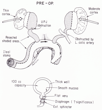 Urinary Tract Reconstruction Patient 6: Prune Belly Syndrome | W. Hardy ...