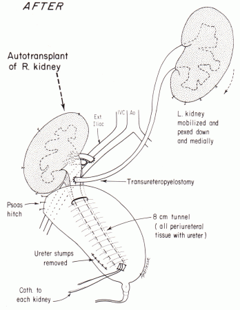 Urinary Tract Reconstruction Patient 7: Strictured Ileal Loop | W ...