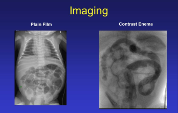 #CBCLIPS Episode 31: Newborn Male with Bowel Obstruction | W. Hardy ...