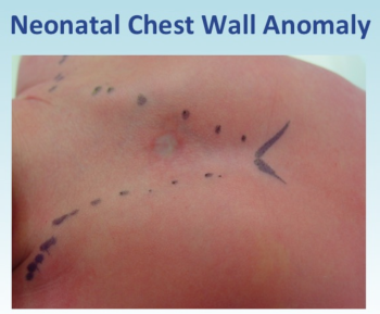 #CBCLIPS Episode 34: Newborn Girl with Chest Wall Anomaly | W. Hardy ...